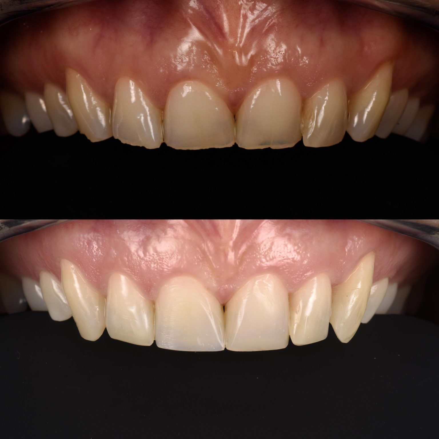 Edge-Bonding I Komposittfylling I Godtanna Løten