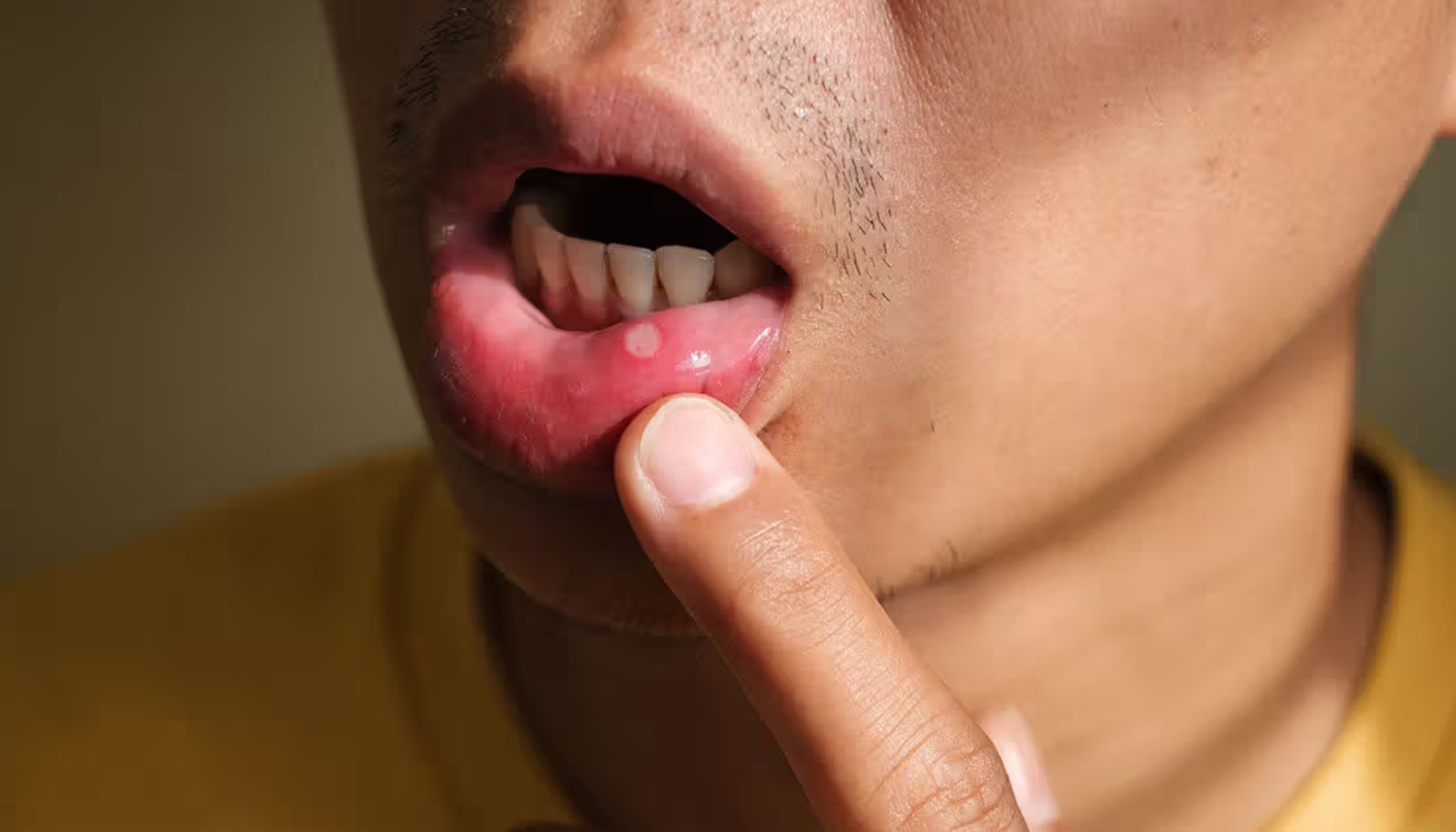 Slik Forebygger Du Mandelsteiner | Godtanna Løten Tannlegesenter